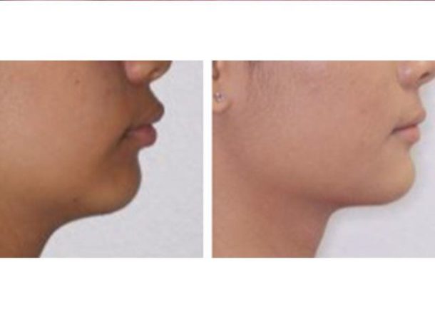 Common Orthodontic Problems | Braces & Invisalign Colorado | Shine ...