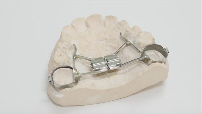 Palatal Expander Care | Shine Orthodontics